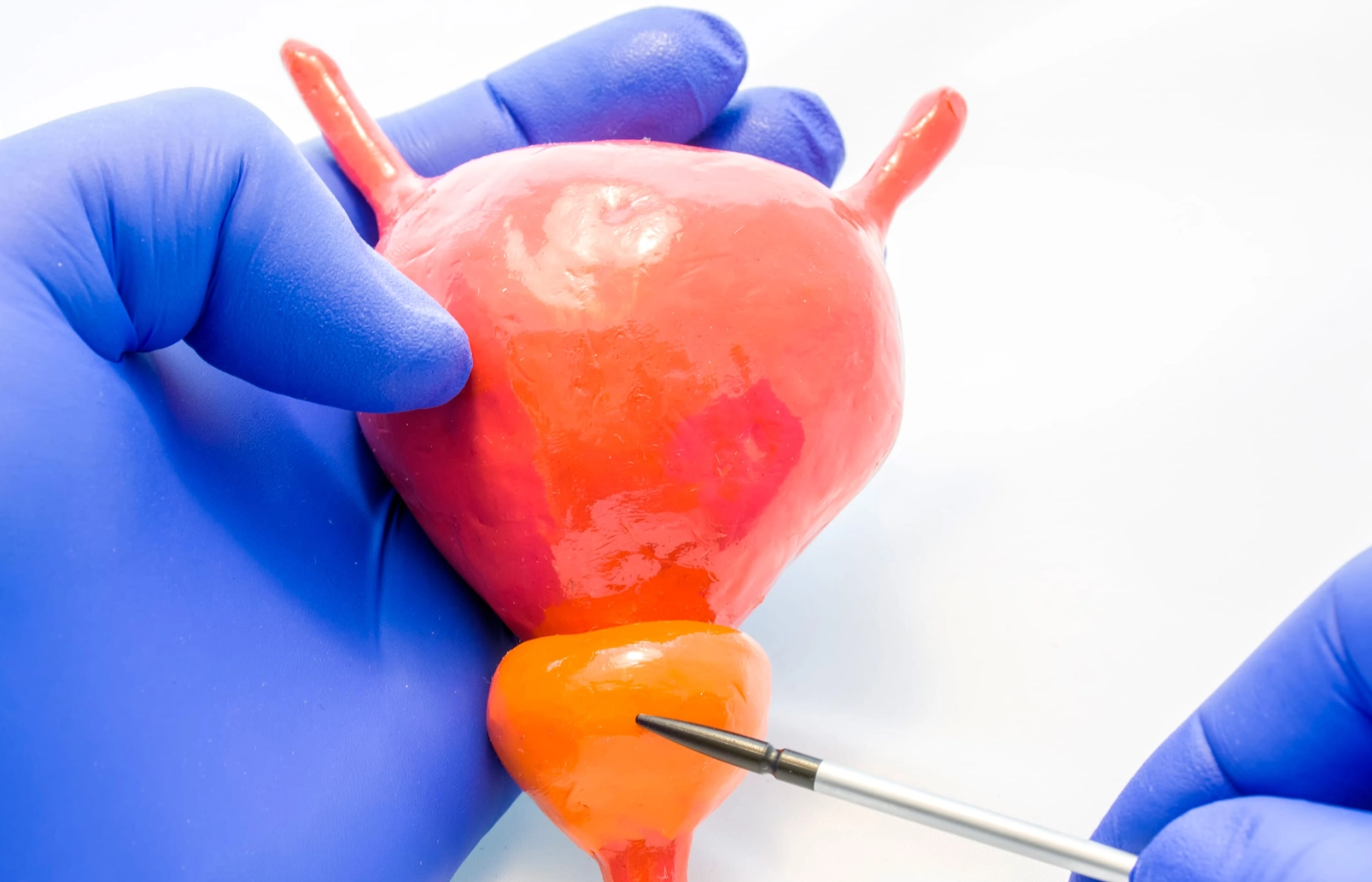 Prostatite - Dr. Marco Lipay Urologia